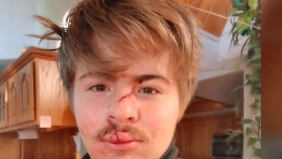 Bear Pushes Through Bedroom Window Screen And Injures 19-Year-Old ...